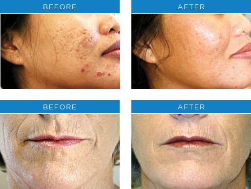 Profractional Skin Treatment at A&E and SNY